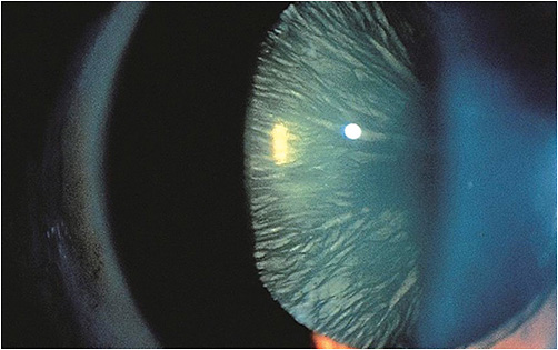 Snowflake Cataract Enzyme Deficiency