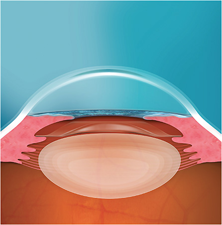 EVO ICL: A Game Changer in Refractive Surgery | Presbyopia Physician
