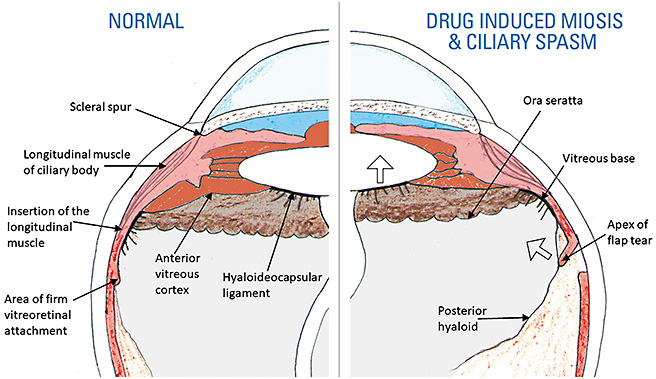 Presbyopia Physician | PentaVision